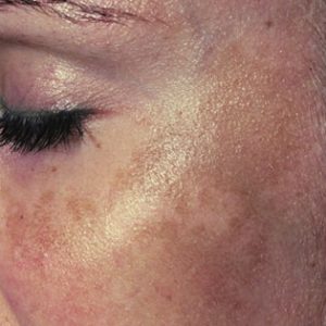 Treating Hyperpigmentation and Melasma: Part 1 - Family Savvy