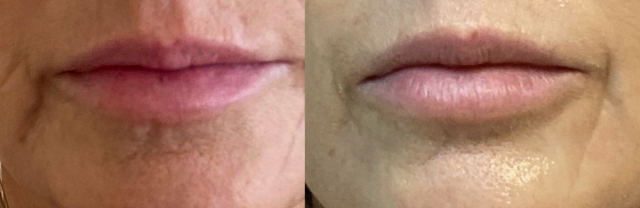 What You Need to Know About Kysse~the New Injectable Lip Filler ...